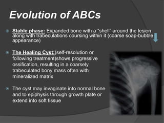 Aneurysmal bone cyst.pptx