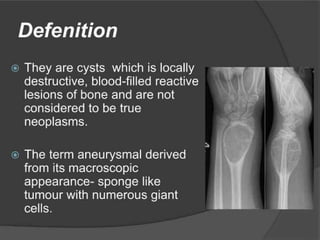 Aneurysmal Bone cyst presentation ortho.pptx