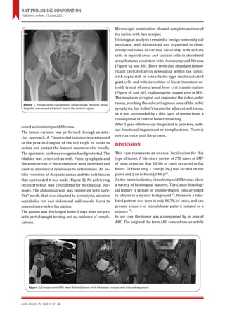 Aneurysmal bone cyst arising in iliopubic chondromyxoid fibroma – a ...