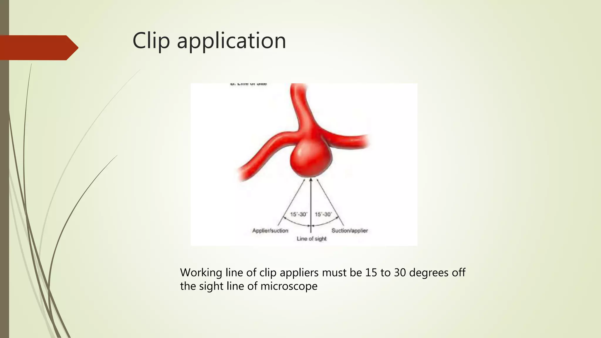 Aneurysm clips /clipology | PPTX