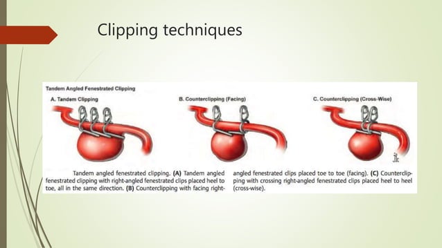 Aneurysm clips /clipology | PPTX | First Aid | Injuries