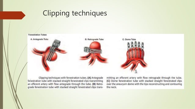 Aneurysm clips /clipology