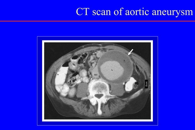 Abdominal Aortic Aneurysm | PPT | Heart and Cardiovascular Diseases | Diseases and Conditions