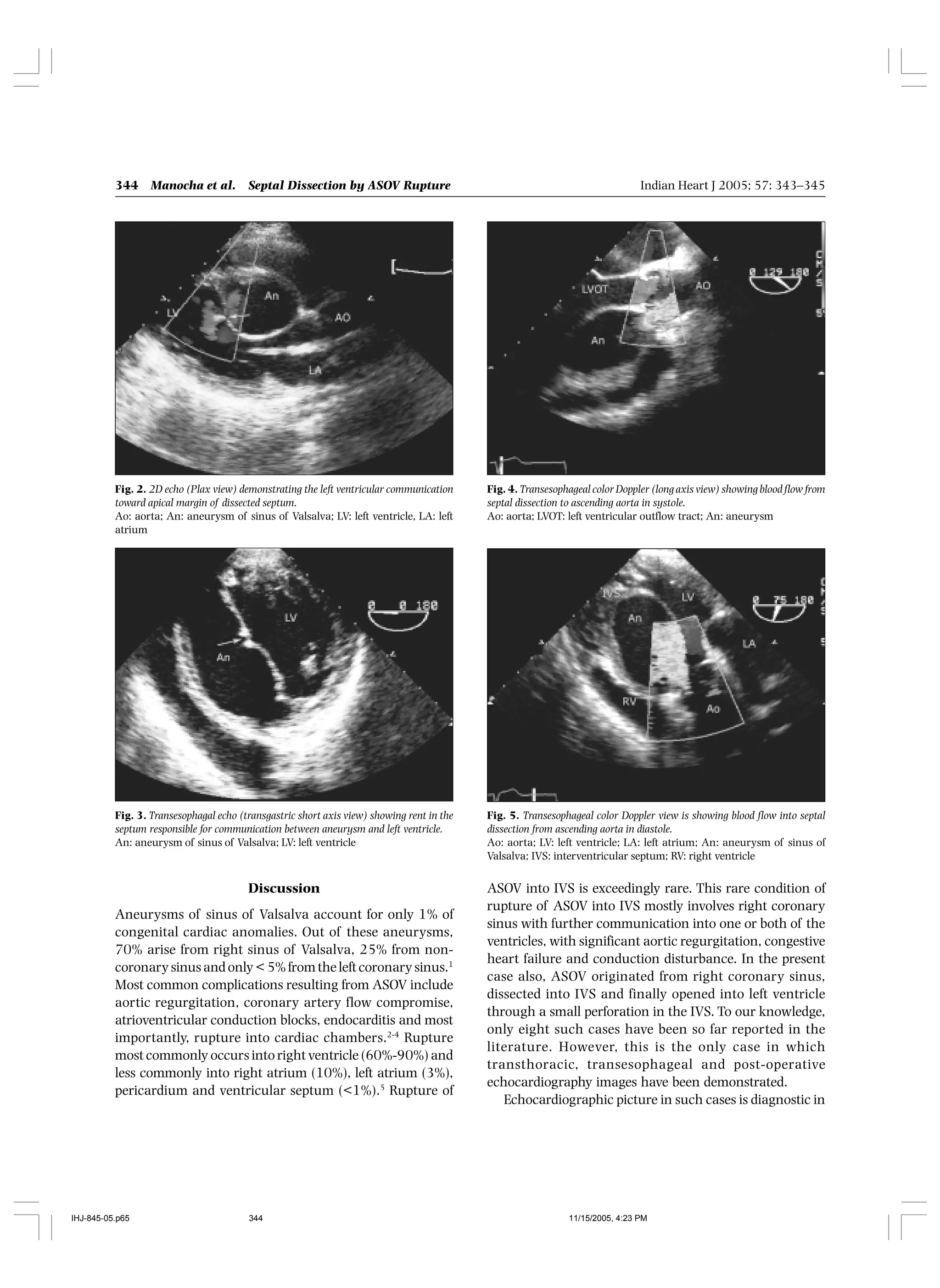 Aneurysm of sinus of valsalva | PDF