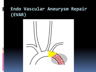 Aneurysm repair Open vs EVAR SLSVS.ppt