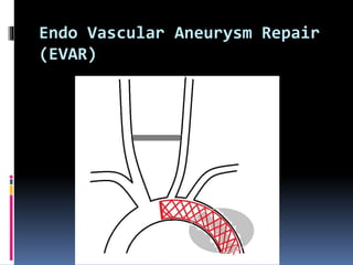 Aneurysm repair Open vs EVAR SLSVS.ppt