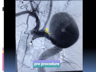 Aneurysm repair Open vs EVAR SLSVS.ppt