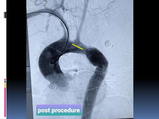 Aneurysm repair Open vs EVAR SLSVS.ppt