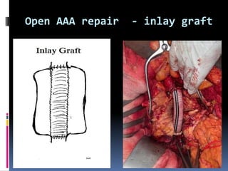 Aneurysm repair Open vs EVAR SLSVS.ppt