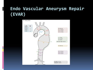 Aneurysm repair Open vs EVAR SLSVS.ppt