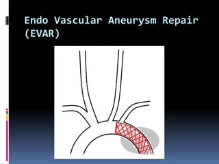 Aneurysm repair Open vs EVAR SLSVS.ppt