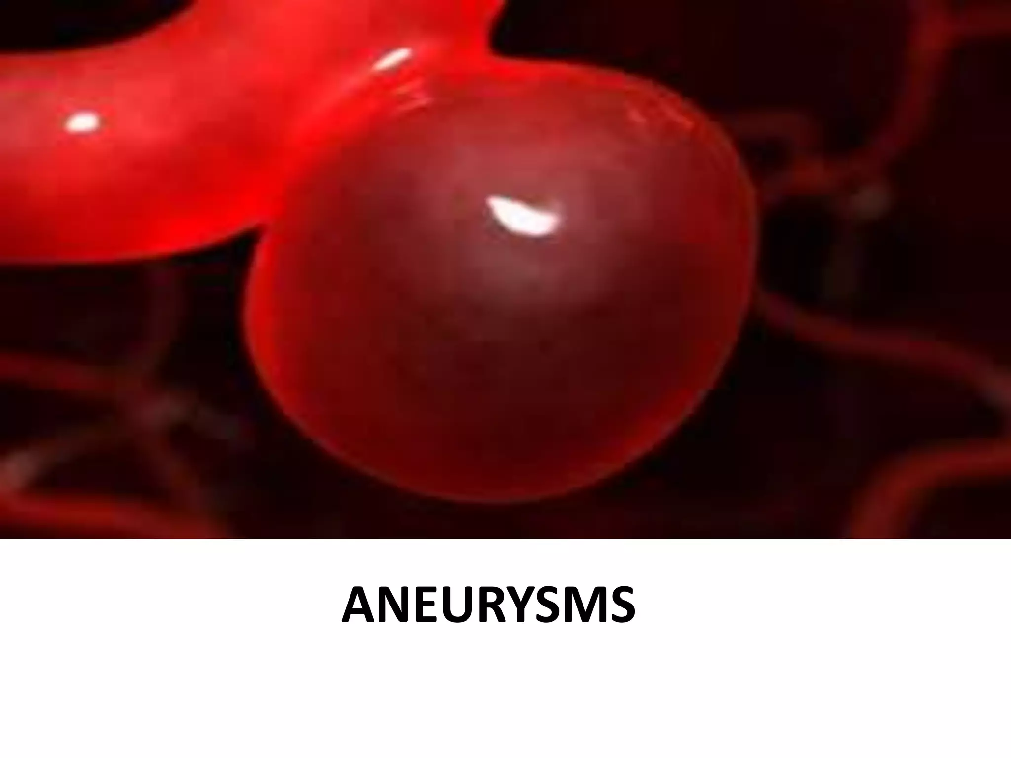 Aneurysms | PPTX