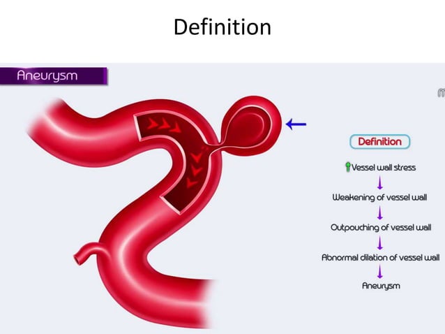 Aneurysms | PPTX | Heart and Cardiovascular Diseases | Diseases and ...
