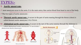 aneurysms.pdf