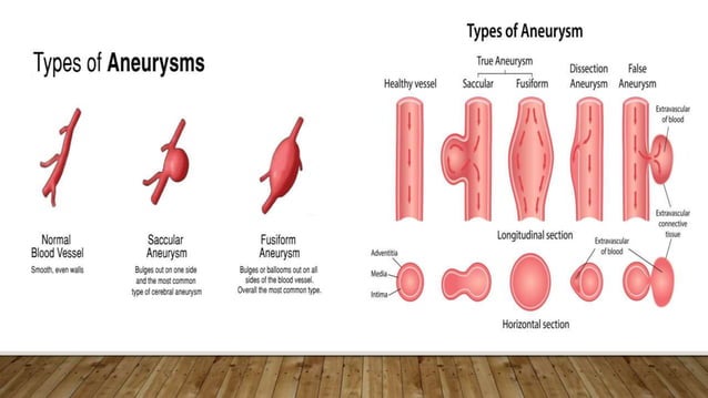 aneurysms.pdf