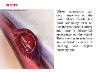 Aneurysms its Causes, Pathophysiology and management | PPT