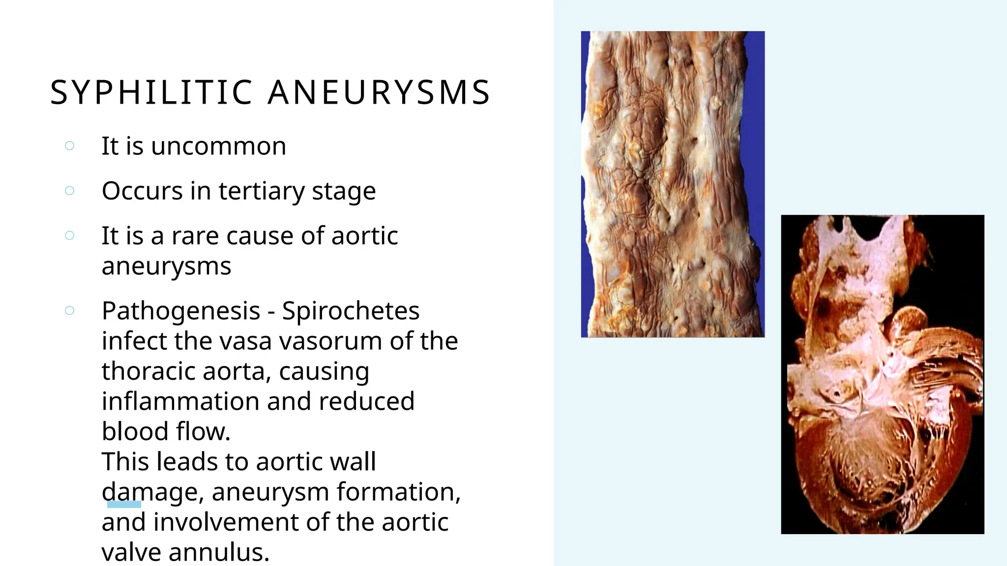 Aneurysms power point presentation_pathology | PPTX
