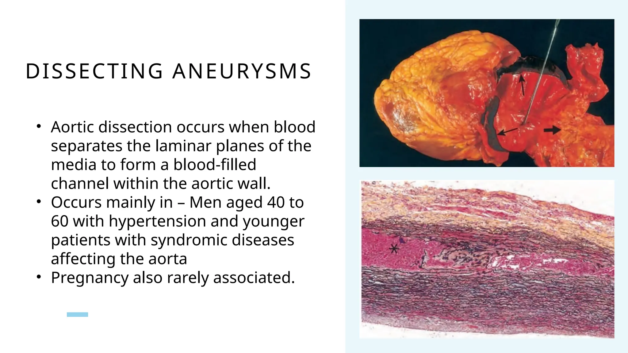 Aneurysms power point presentation_pathology | PPTX