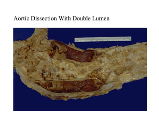 Aneurysms and dissections | PPT