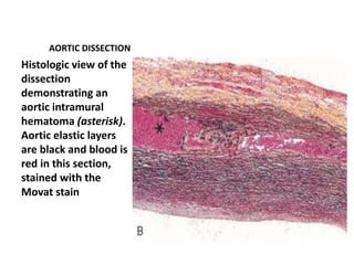 Aneurysms & dissection | PPTX