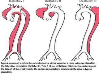 Aneurysms & dissection | PPTX