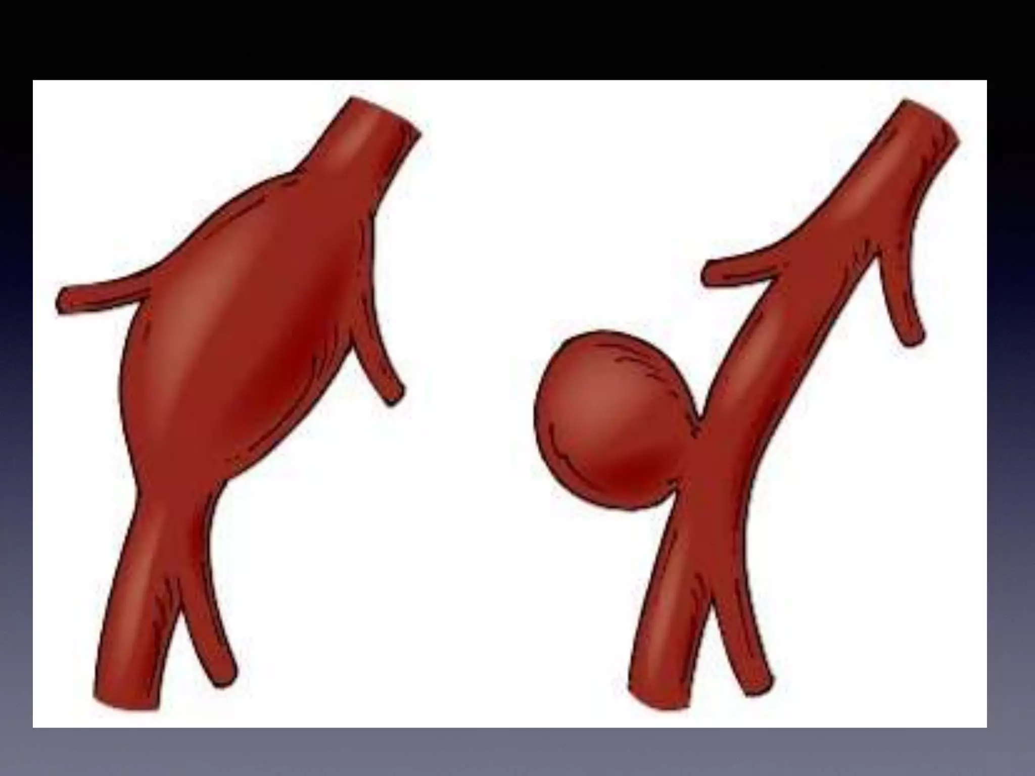 Aneurysms & dissections | PPTX