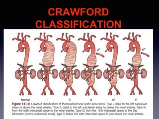 Aneurysms & dissections | PPT
