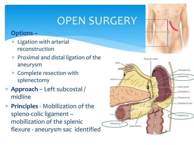 Aneurysms of splanchnic and visceral arteries | PPT