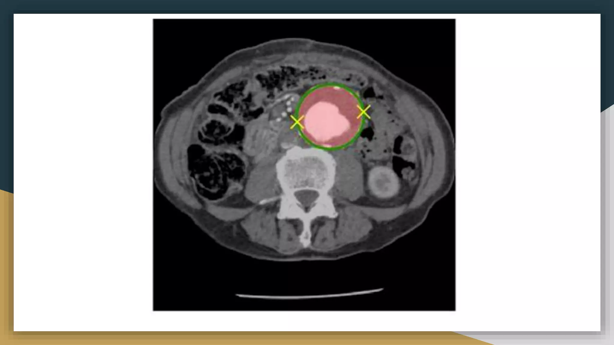 Aneurysms of the aorta and peripheral arteries..pptx