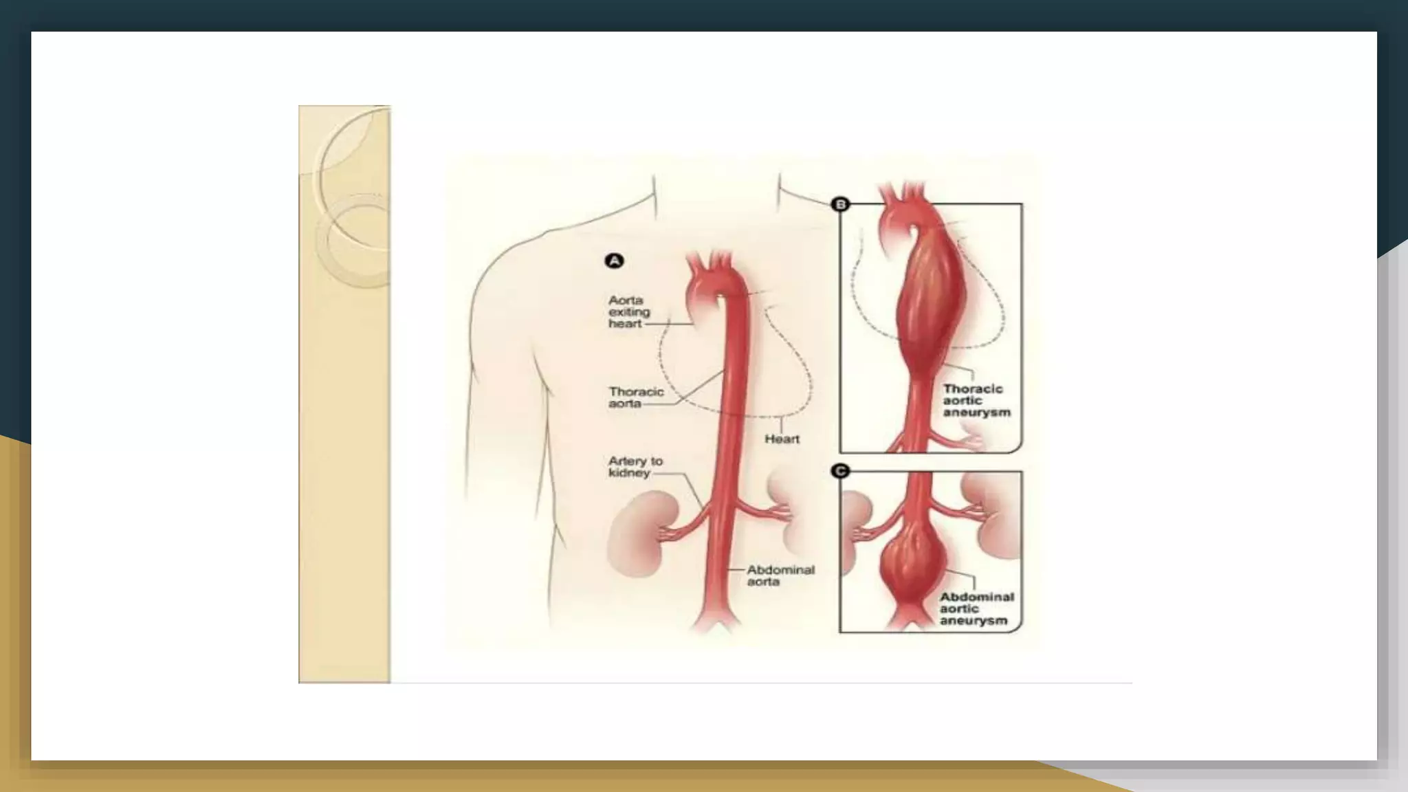 Aneurysms of the aorta and peripheral arteries..pptx