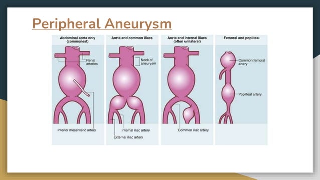 Aneurysms of the aorta and peripheral arteries..pptx