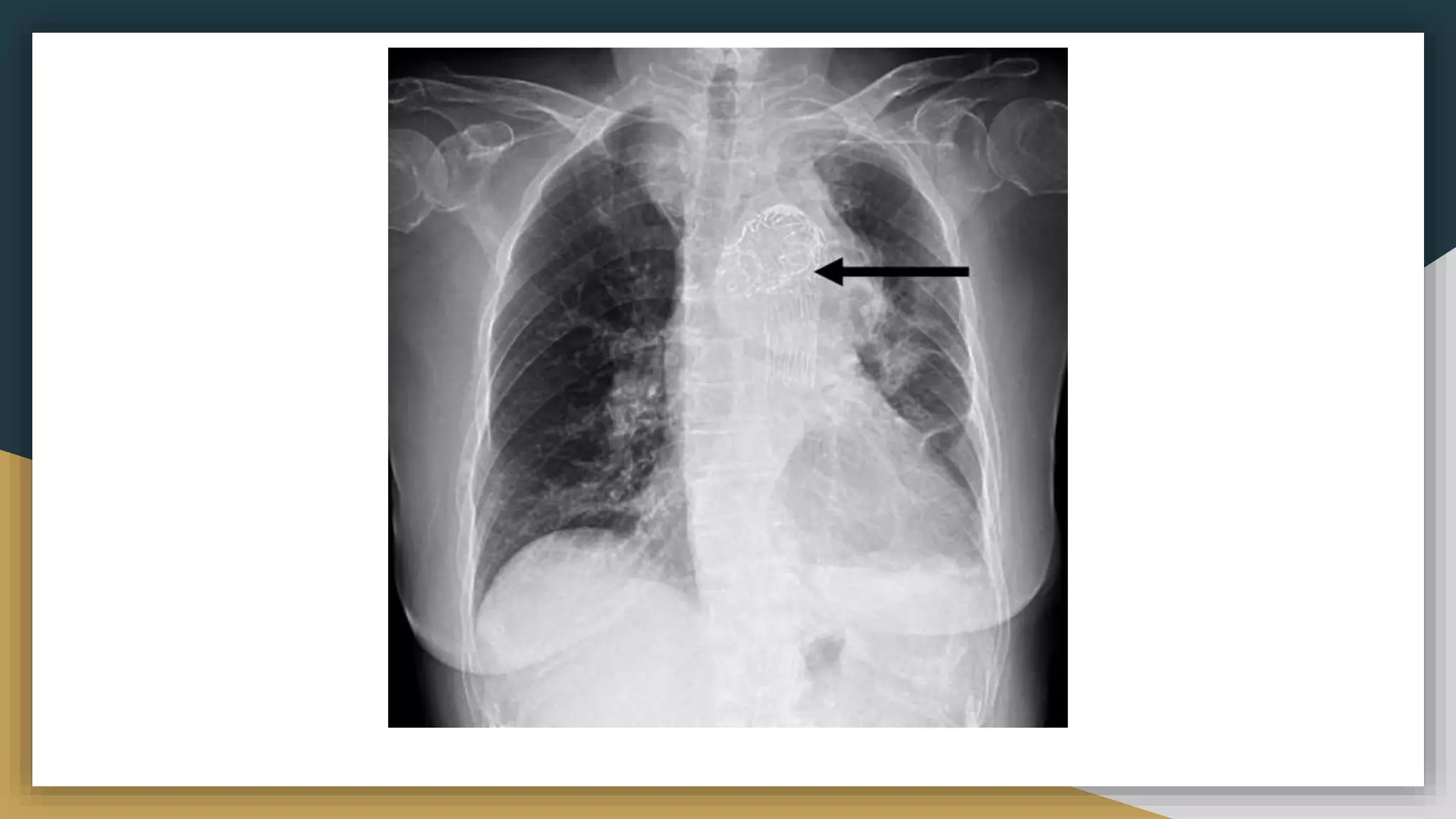 Aneurysms of the aorta and peripheral arteries..pptx