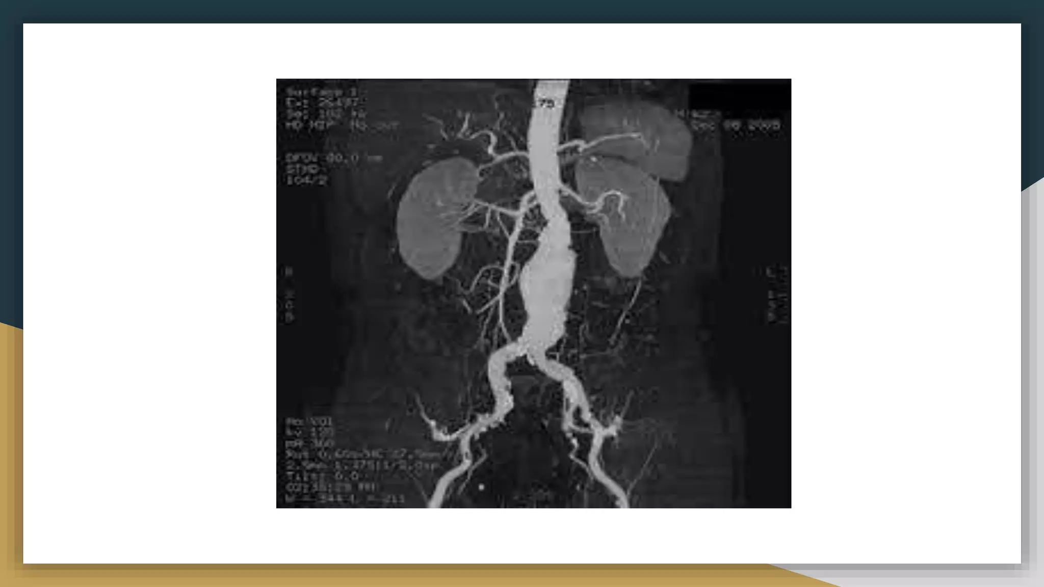 Aneurysms of the aorta and peripheral arteries..pptx