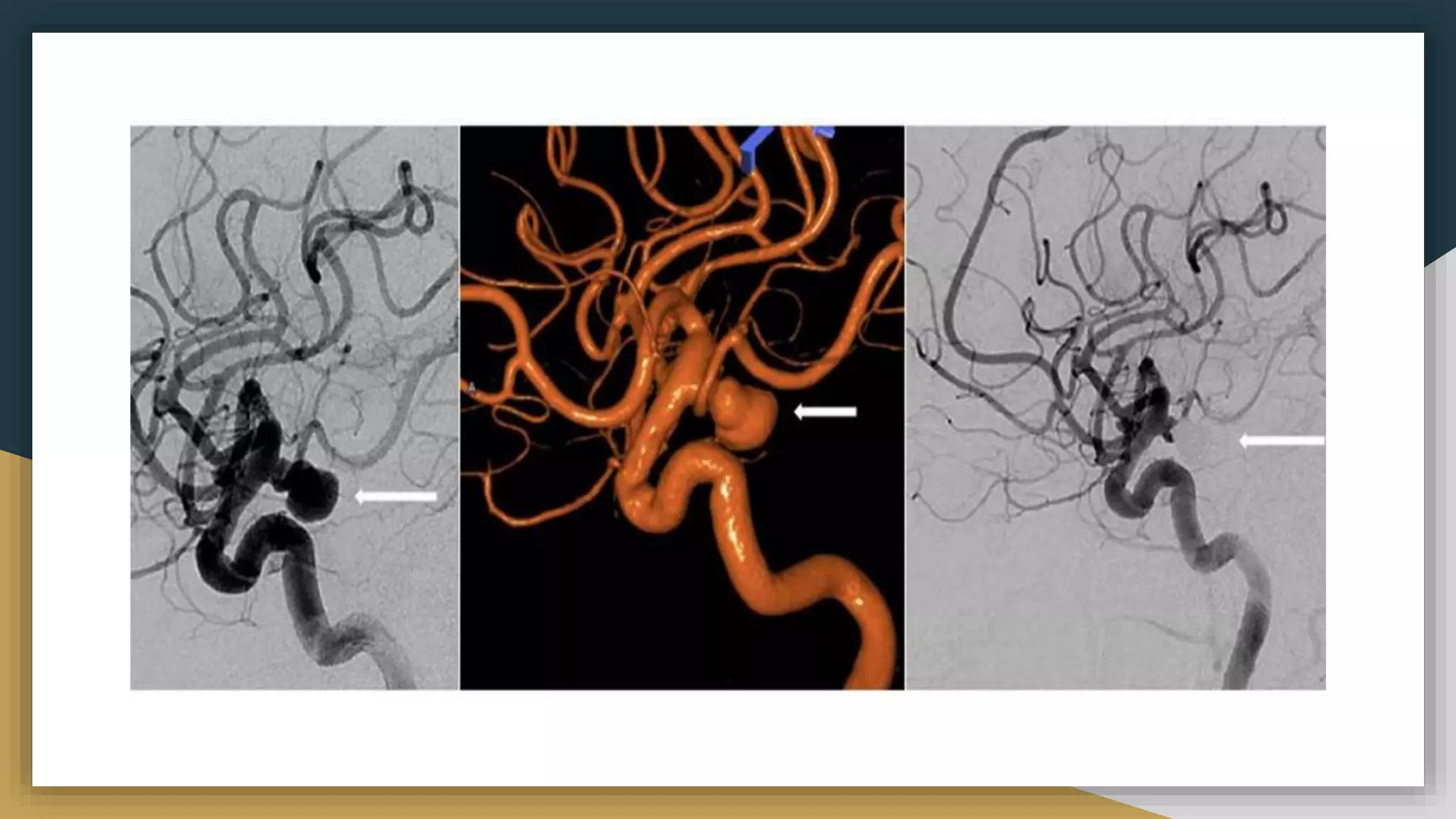 Aneurysms of the aorta and peripheral arteries..pptx