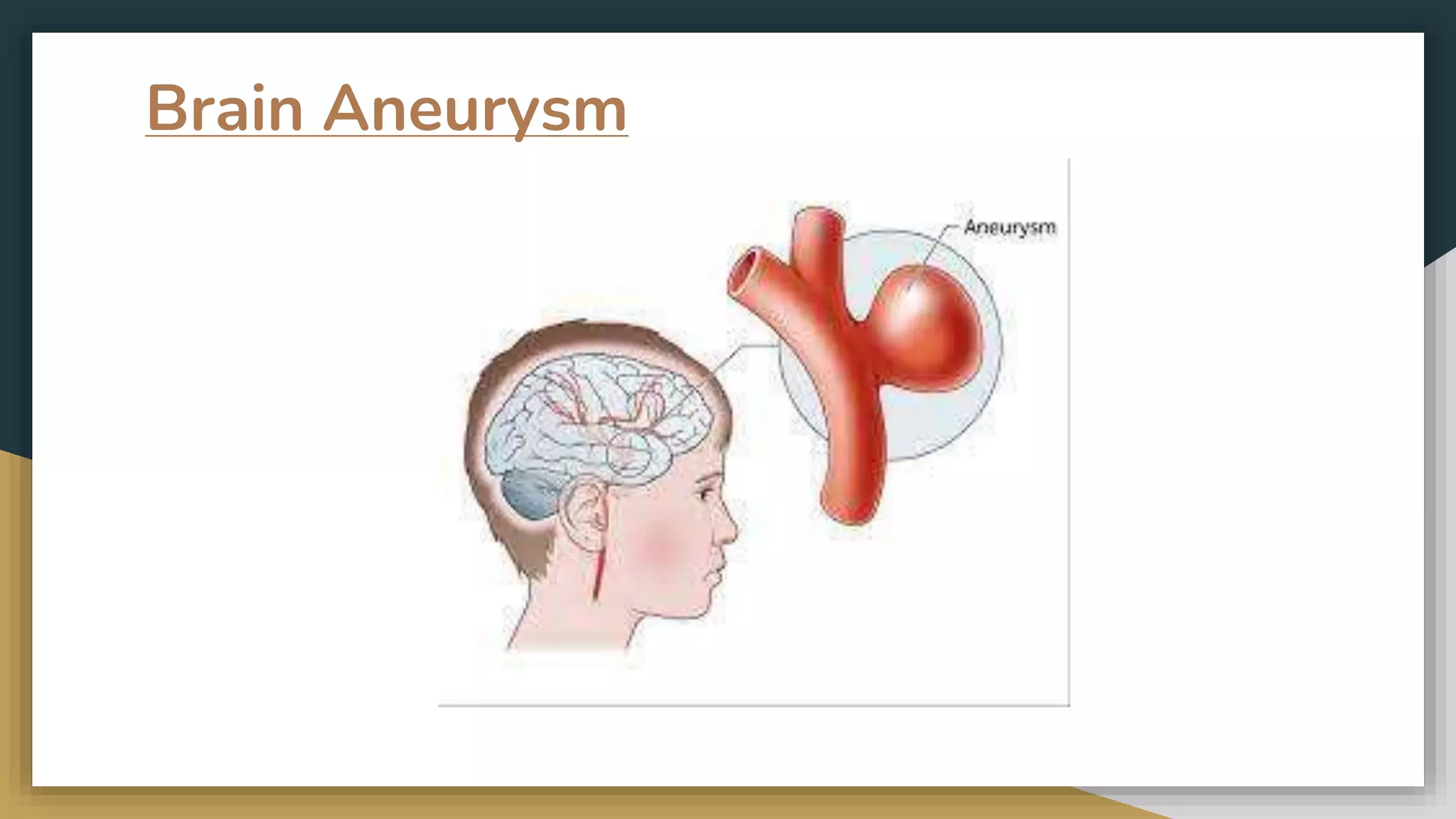 Aneurysms of the aorta and peripheral arteries..pptx