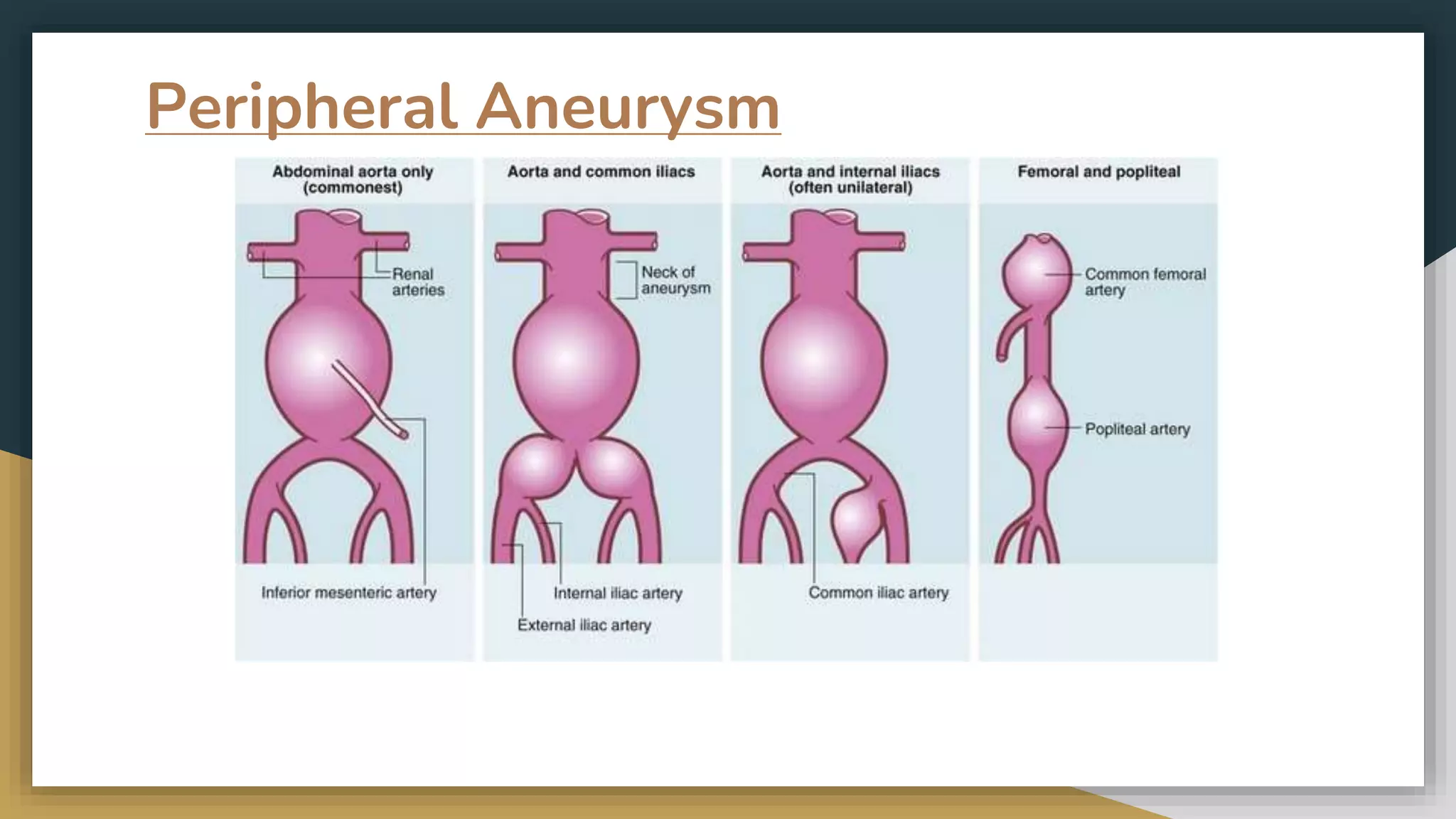 Aneurysms of the aorta and peripheral arteries..pptx