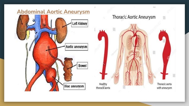 Aneurysms of the aorta and peripheral arteries..pptx