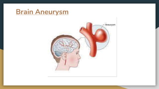 Aneurysms of the aorta and peripheral arteries..pptx