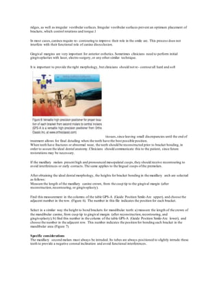 Smile arc Protection A new table to guide bracket placement based on ...