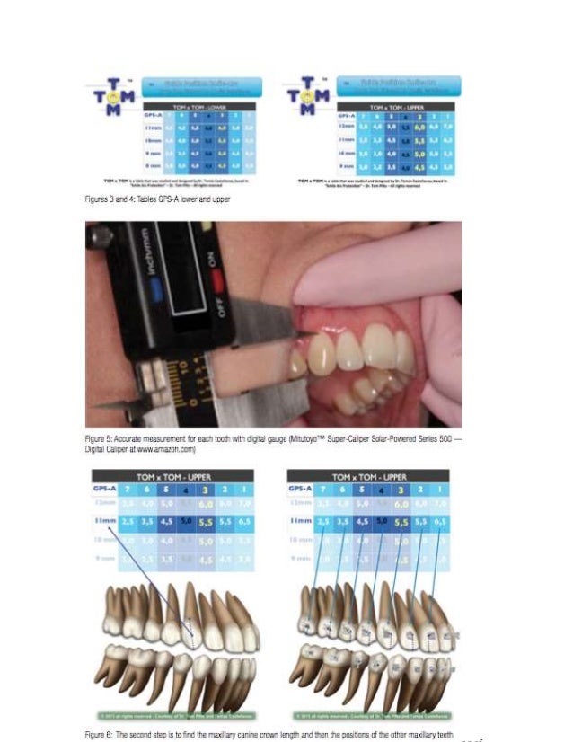 Smile arc Protection A new table to guide bracket placement based on