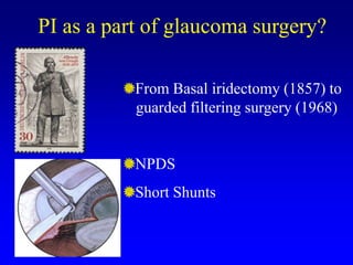 A new technique for trabeculectomy | PPTX
