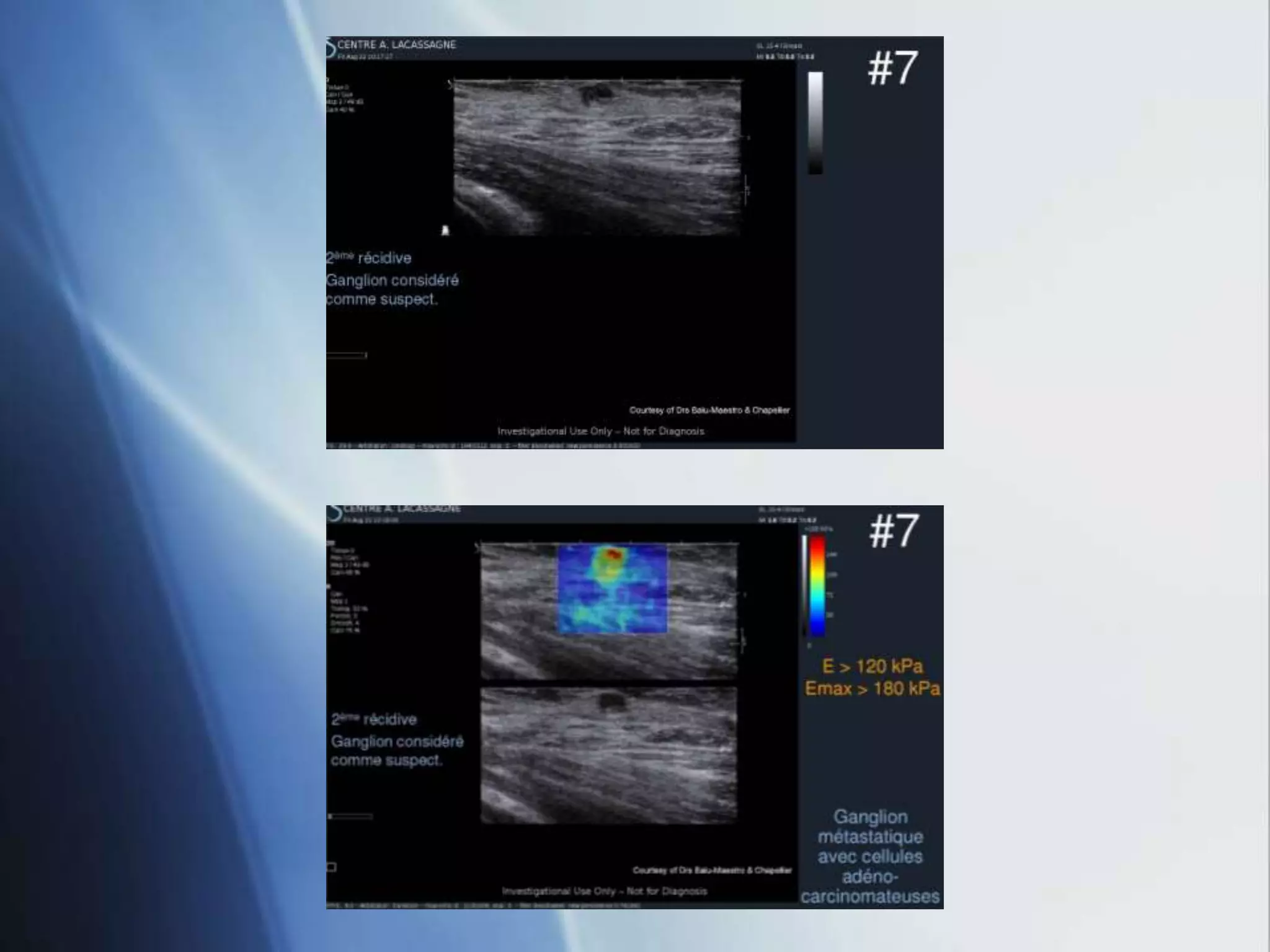 A new Ultrasound modality Elastography.ppt