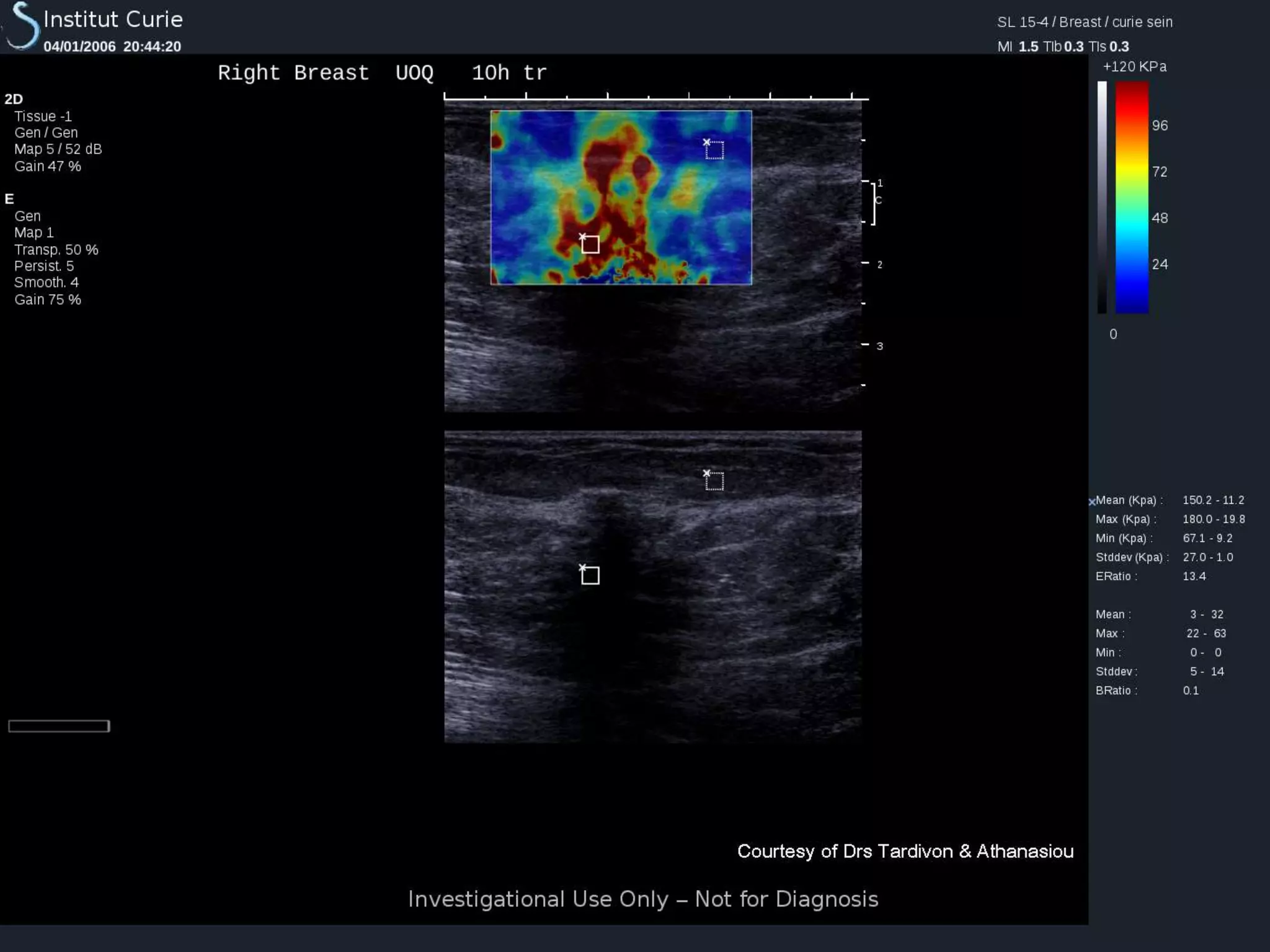 A new Ultrasound modality Elastography.ppt