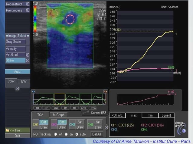 A new Ultrasound modality Elastography.ppt