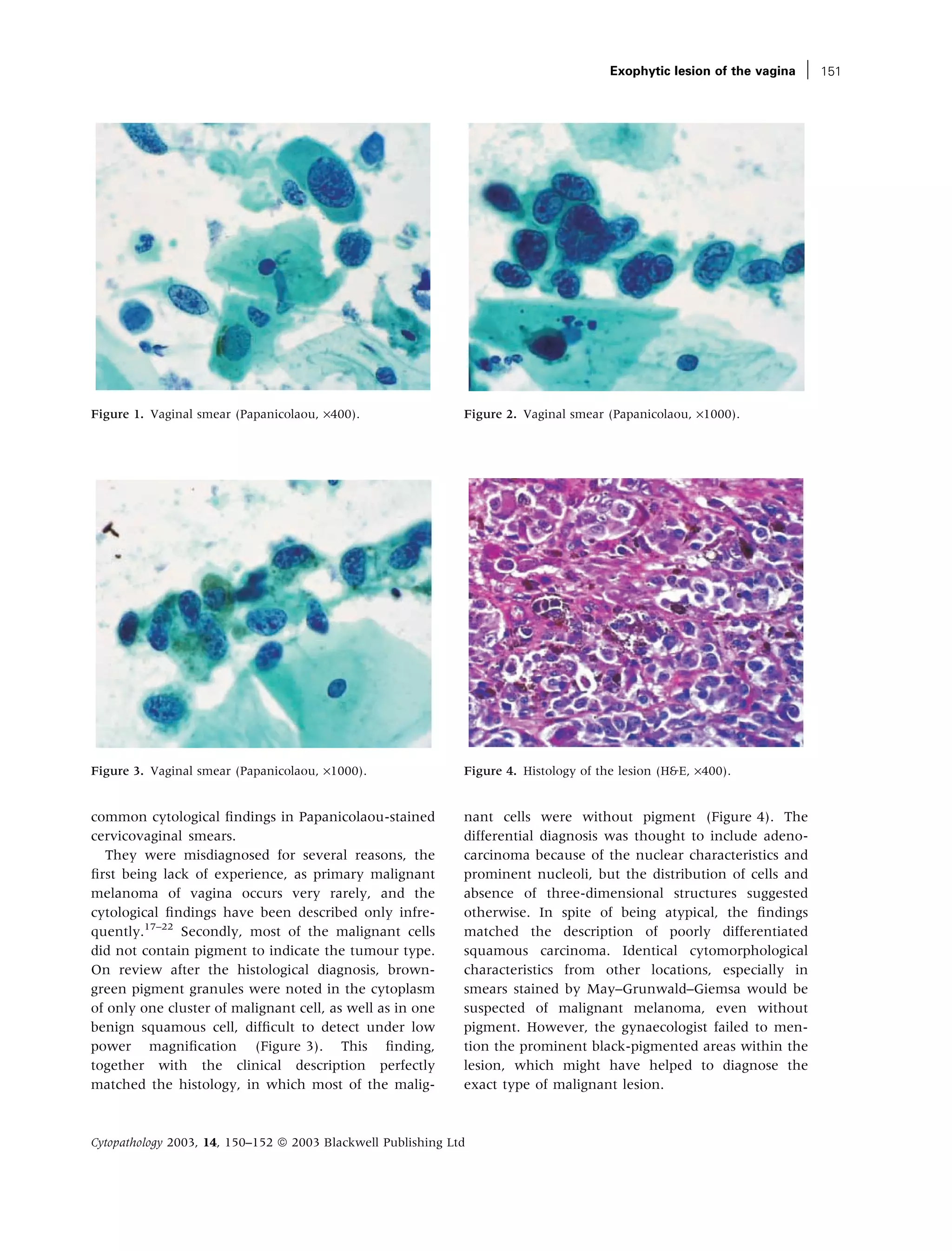 An exophytic lesion of the vagina cytological findings | PDF