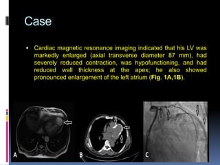 An extensive calcified left ventricular aneurysm | PPT