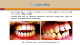 Orthodontics ----open bite ppt final.pptx