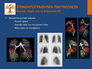Πνευμονική εμβολή: Σπινθηρογράφημα πνευμόνων | PPT
