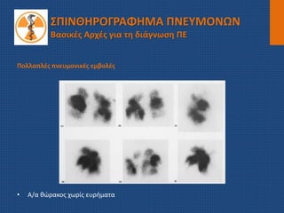 Πνευμονική εμβολή: Σπινθηρογράφημα πνευμόνων | PPT