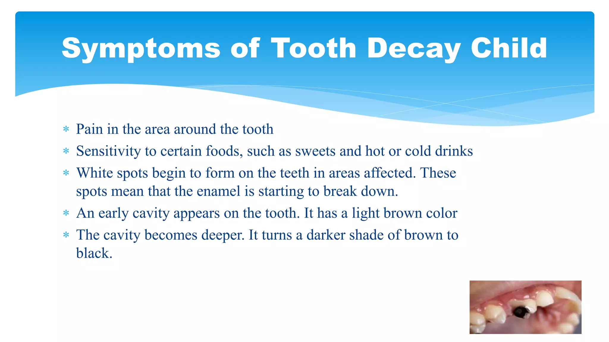 Tooth decay in children | PPTX
